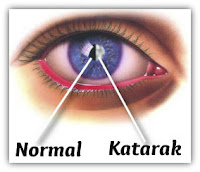 Pengertian Katarak dan Penyebab Katarak - Education Articles