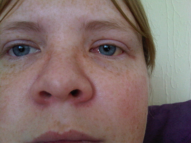 Retinal Detachment - My Story: Day 8 - (one week since surgery)