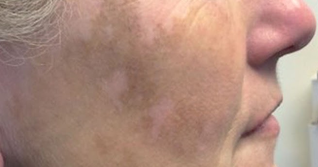 How Vitiligo Affects An Individual Life?: Ayurveda Treats White Patches ...