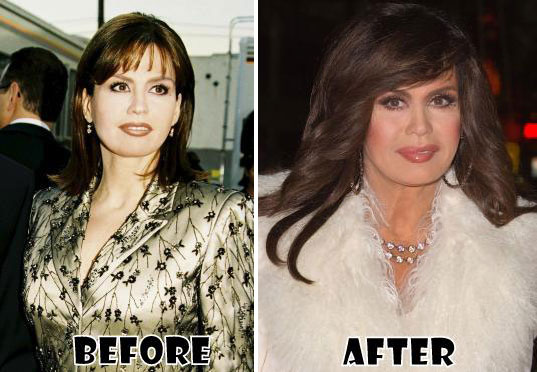 Marie Osmond Plastic Surgery