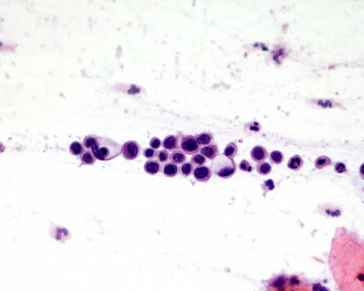 Citología Exfoliativa Mérida: Cáncer In Situ