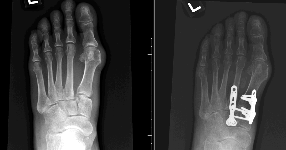 www.lisfranc.ca - Lisfranc Fracture / Injury Blog: Lisfranc / Midfoot ...