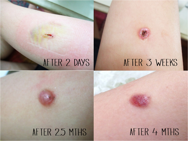 Mole Removal Surgery | Part 5 [After 1 year] | MyStyleBite