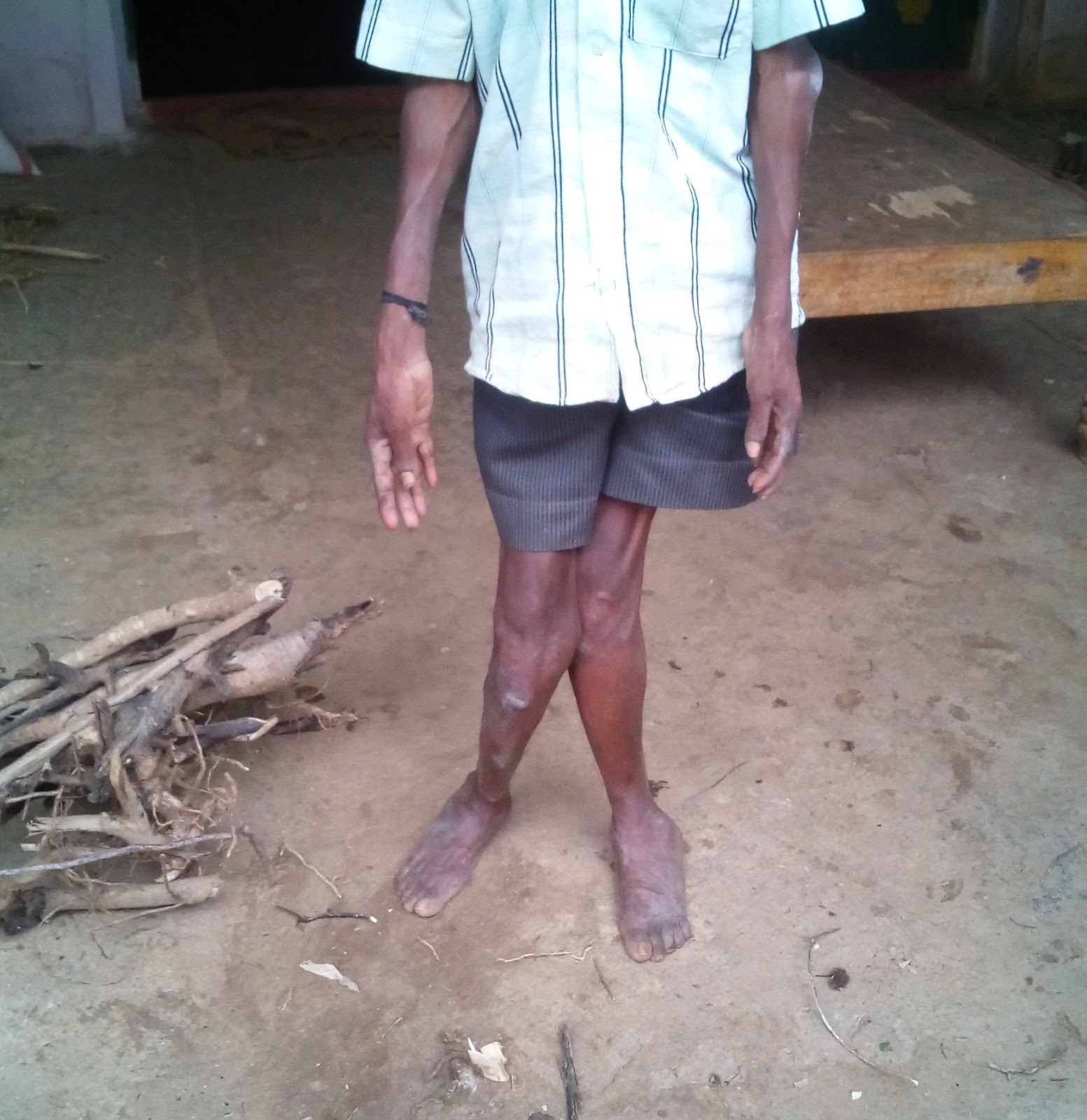 The Story of Crooked limbs in Bagepalli – Biome Environmental Trust