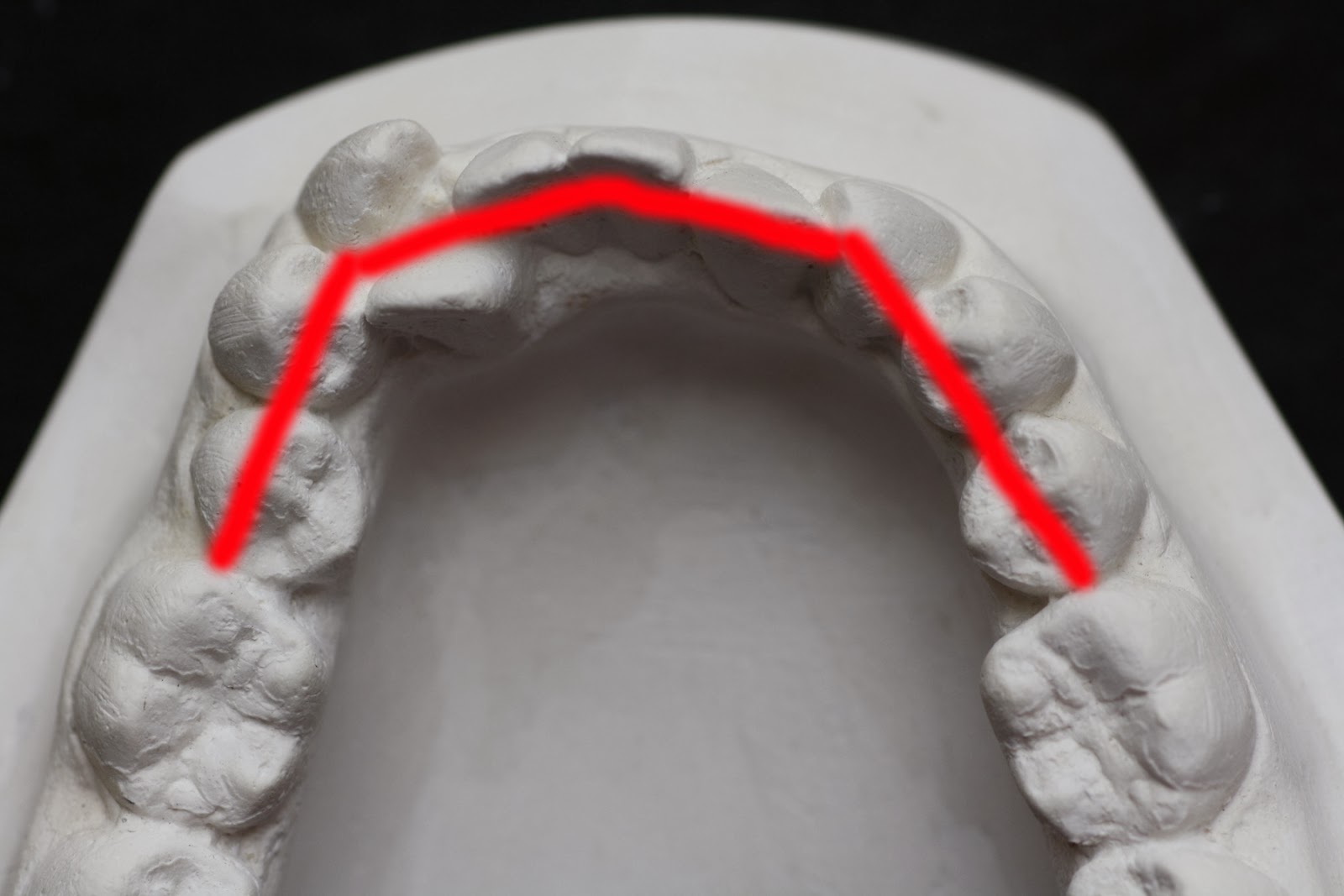 Orthodontics: UG Model Analysis Measurement of crowding and spacing