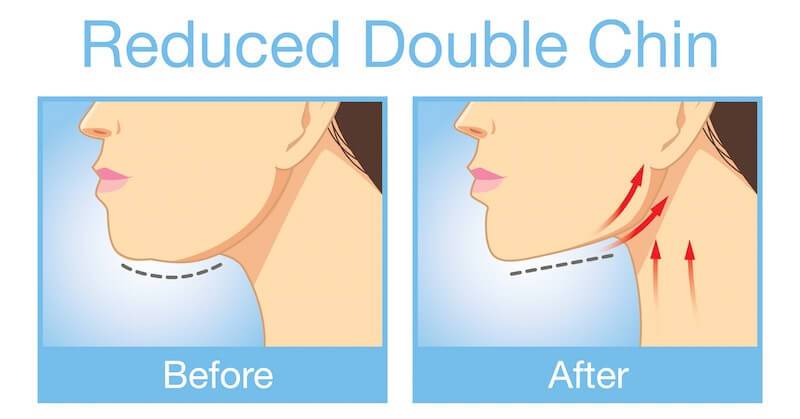 Get Rid Of Double Chin and Tone Your Neck with These 10 Simple Exercises