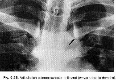 Tecnicas Radiológicas 2011: Articulaciones Esternoclaviculares ...
