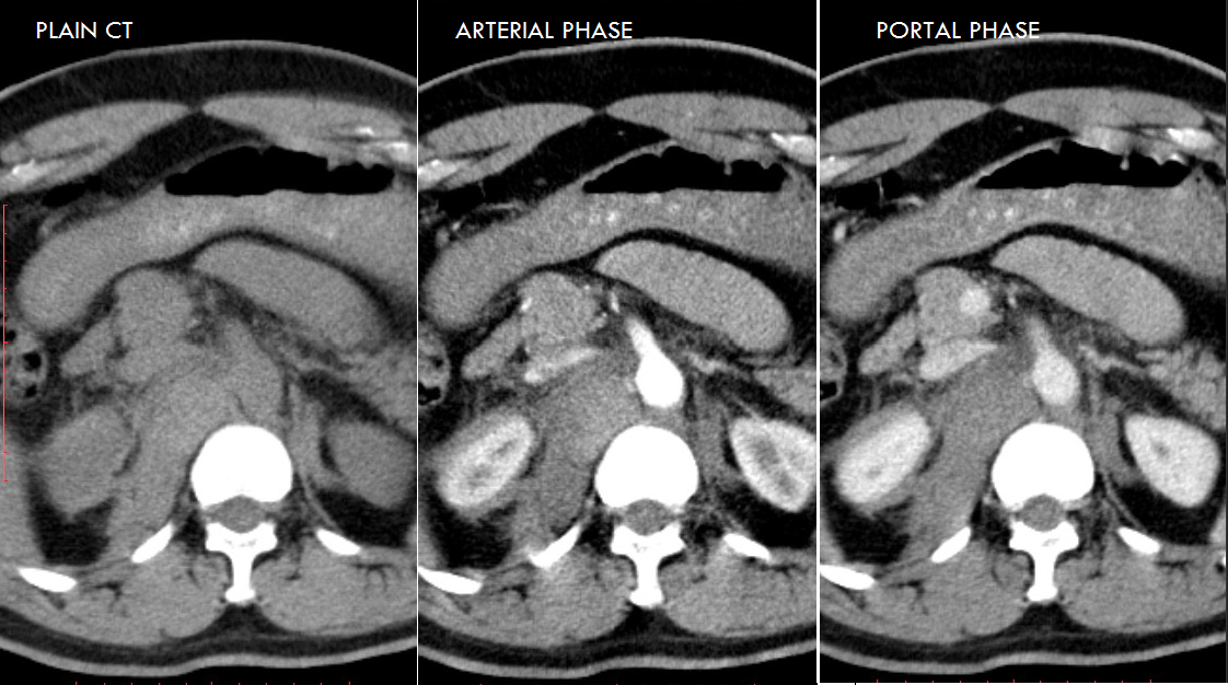 Ultimate Radiology : Active arterial extravasation in Blunt Abdominal ...