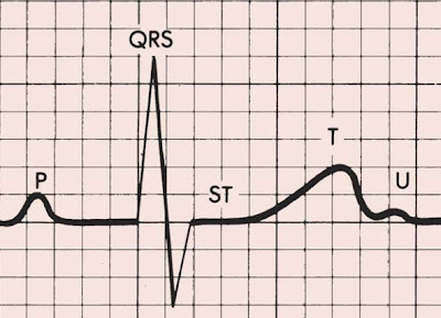 ECG T wave changes and interpretation