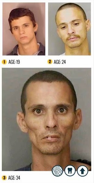 Krokodil, The Flesh-Eating Street Drug That Rots Skin From Inside-Out ...