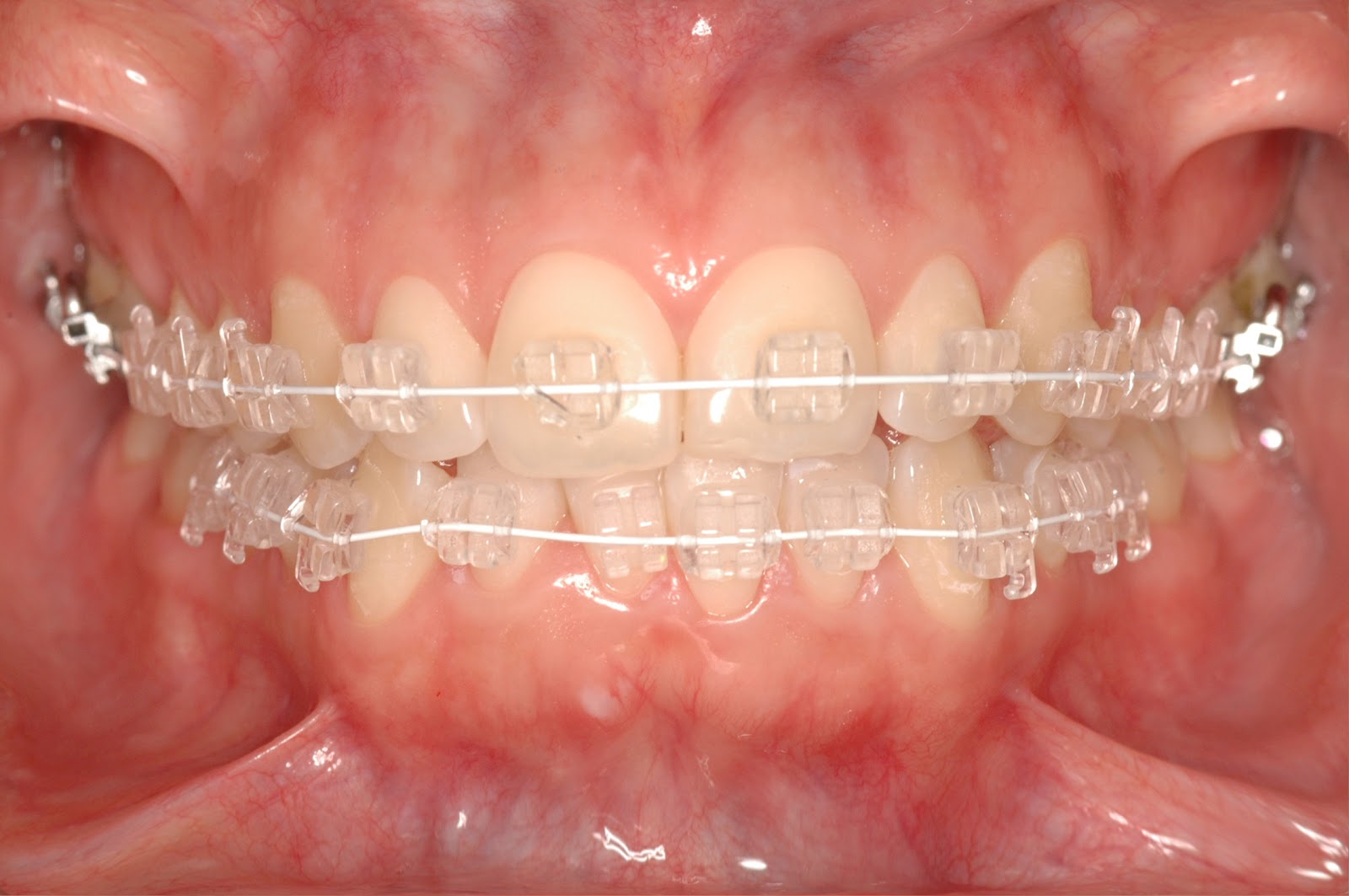 ORTHODIAMOND: Braquetes Safira Inspire ICE: Uma alternativa estética ...