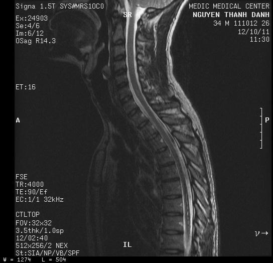 MRI MEDIC CASE STUDIES COLLECTION: INTRAMEDULLARY SPINAL CORD TUMOR