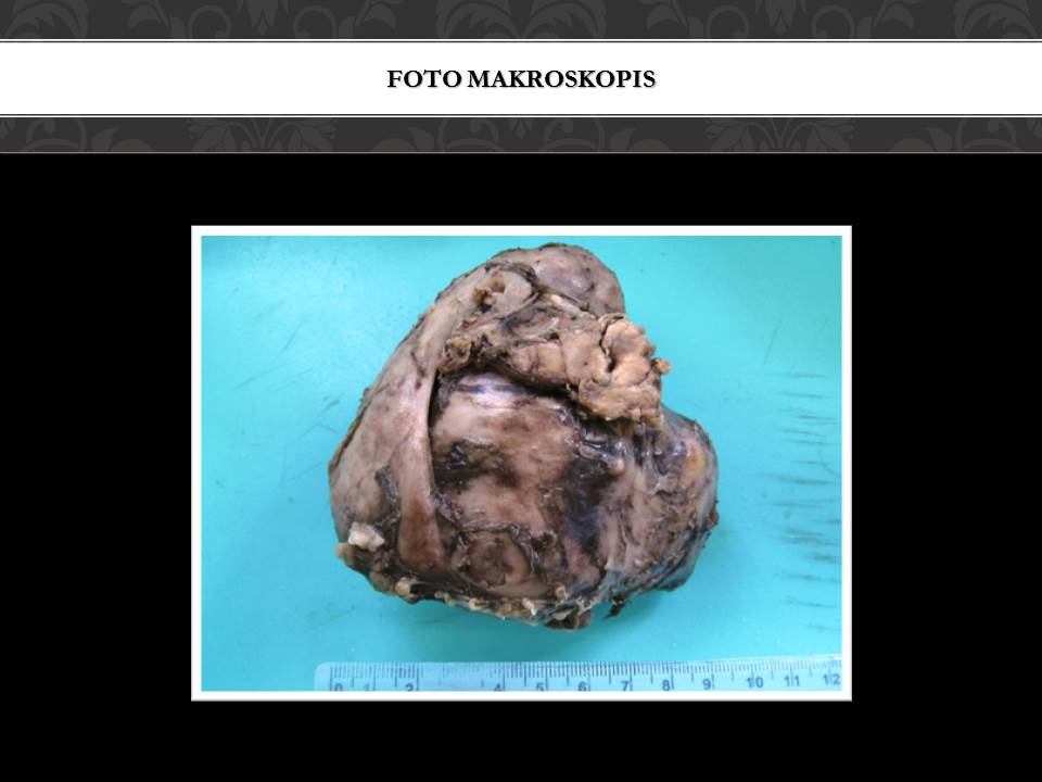 Reza Aditya Digambiro: PAPILLARY RENAL CELL CARCINOMA (GRAWITZ TUMOUR)