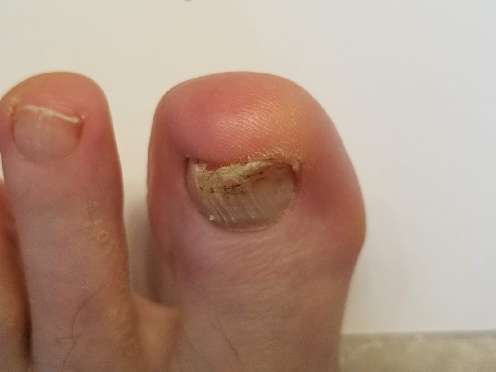 Run with Perseverance: A Tale of Two Toenails; How to Fix Runner's Toenails