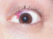 Lentes de Contacto: Derrames y hemorragias en los ojos