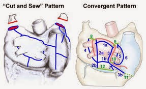 Medical Treatment Pictures-for Better Understanding: Maze Procedure ...