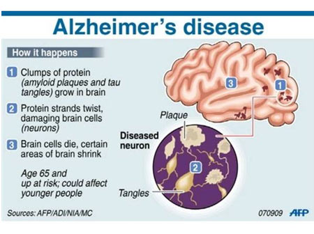 ALZHEIMER'S DISEASE - GENERAL AWARENESS