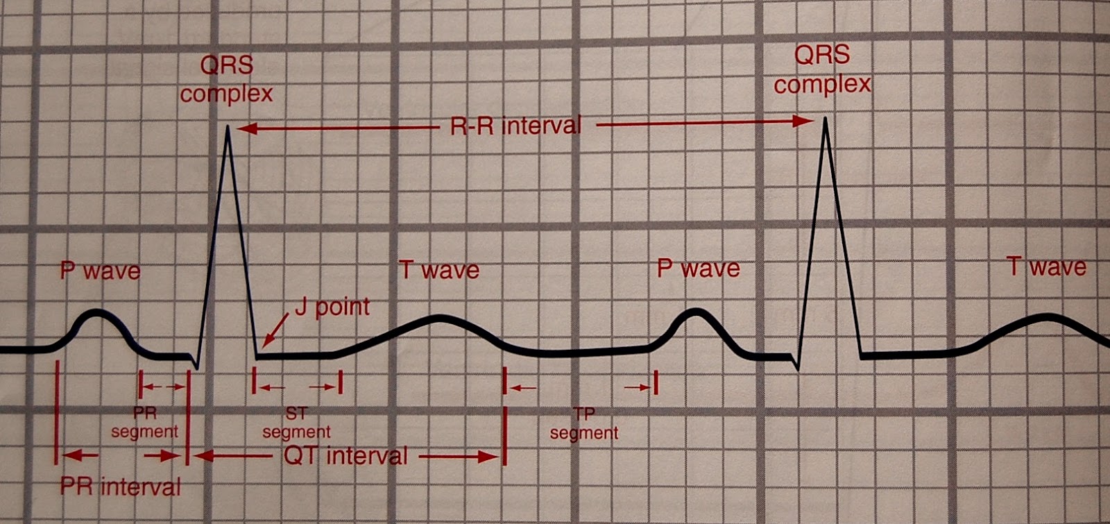 Cardiac Arrythmias and ECG Guidelines
