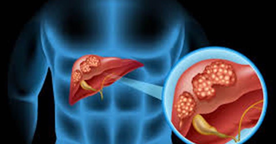 Siete Señales De Alerta De Que Tu Hígado Está Lleno De Toxinas.