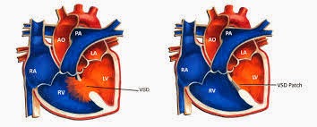 Medical Treatment Pictures-for Better Understanding: Ventricular Septal ...