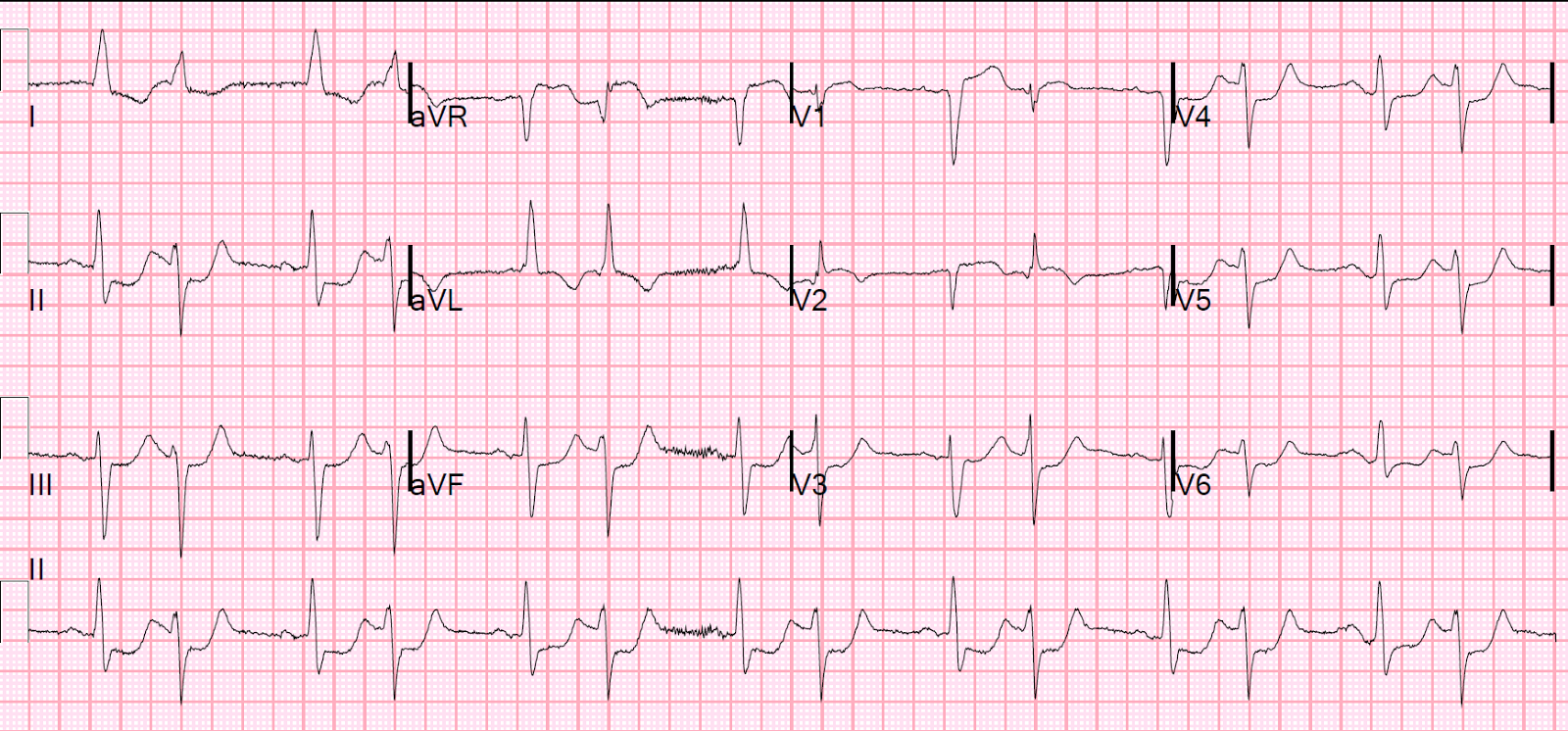 Dr. Smith's ECG Blog: Chest Pain and Cardiogenic Shock with Profound ST ...