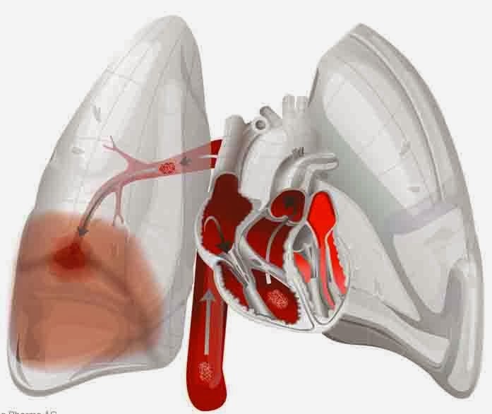 Cara Mengatasi Emboli Paru Dengan Ramuan Alami