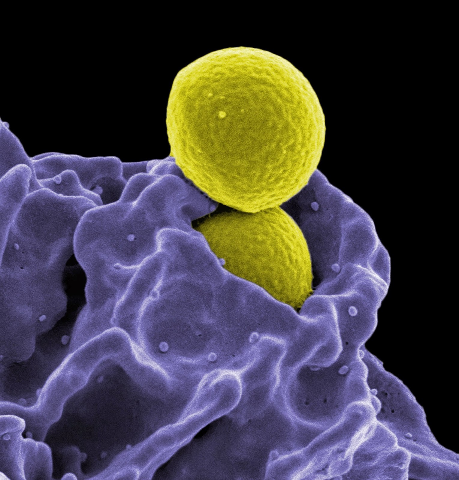 ΛΟΙΜΩΞΗ / INFECTION: MRSA