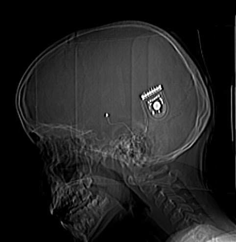 Cochlear implants and the Radiologist - Sumer's Radiology Blog