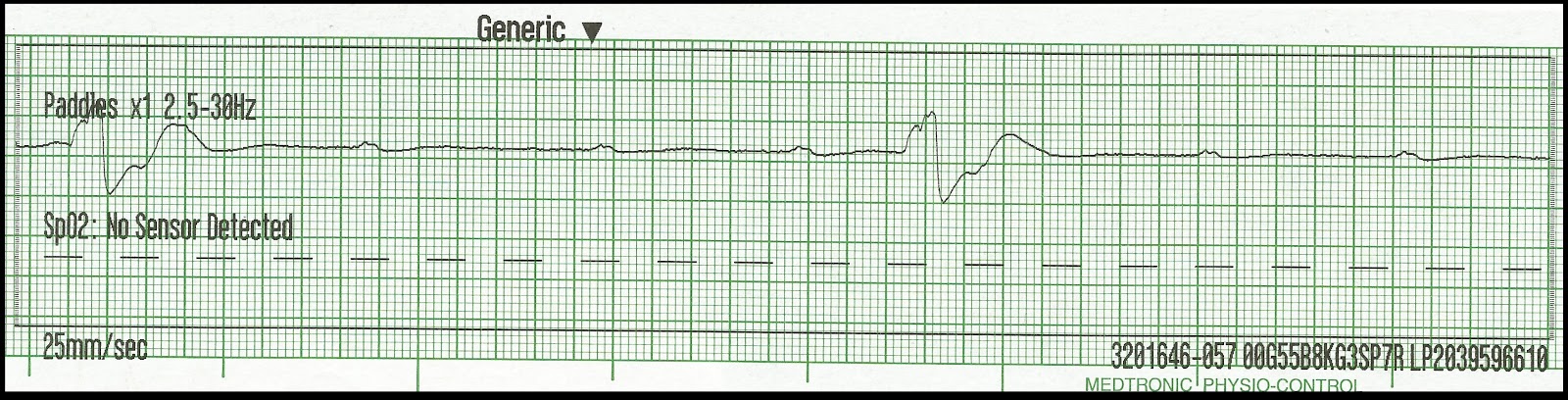 ECG Rhythm Strip Quiz 93