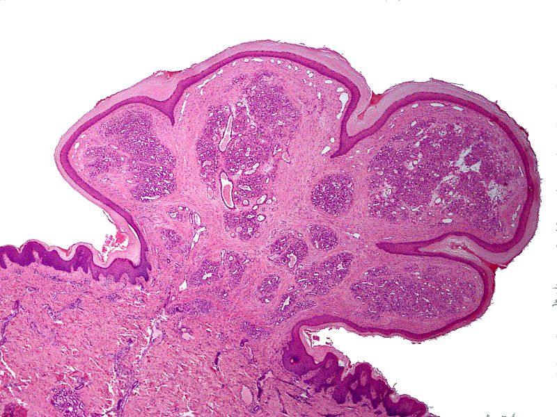 Pyogenic granuloma