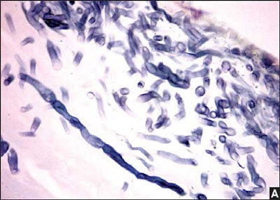 Staining Procedure for Rapid Identification of Fungi | Free Medical Atlas