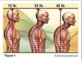 Living with Kennedy's Disease: Dropped-head Syndrome, An Update
