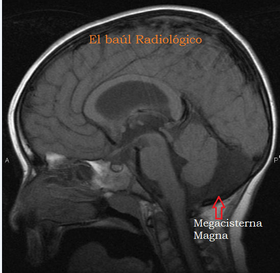 КСС. Череп. Sinus Pericranii. Идиопатический внутричерепной гиперостоз ...