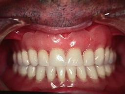 Todo sobre Prótesis Completa Dental (dentadura postiza)