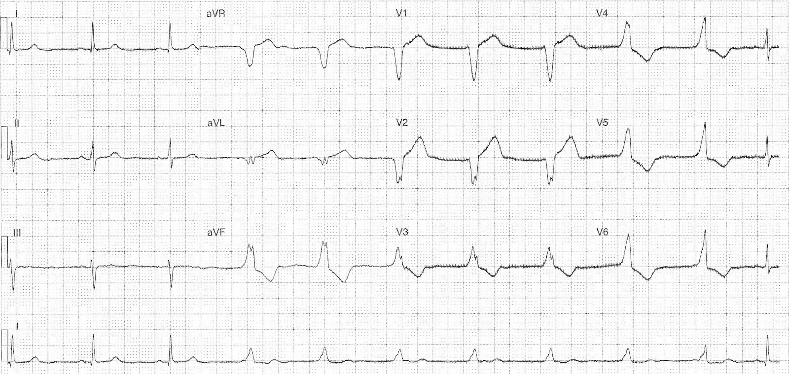 ECG of the Week: ECG of the Week - 21st May 2018 - Interpretation