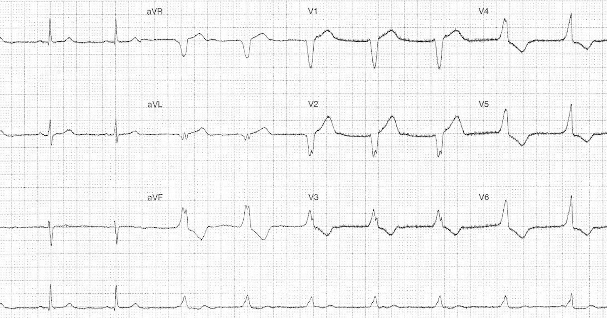 ECG of the Week: ECG of the Week - 21st May 2018 - Interpretation
