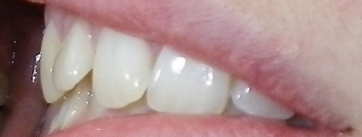 Richard Charon BDS: "Snaggle Teeth" to Lovely Smile with Invisalign®