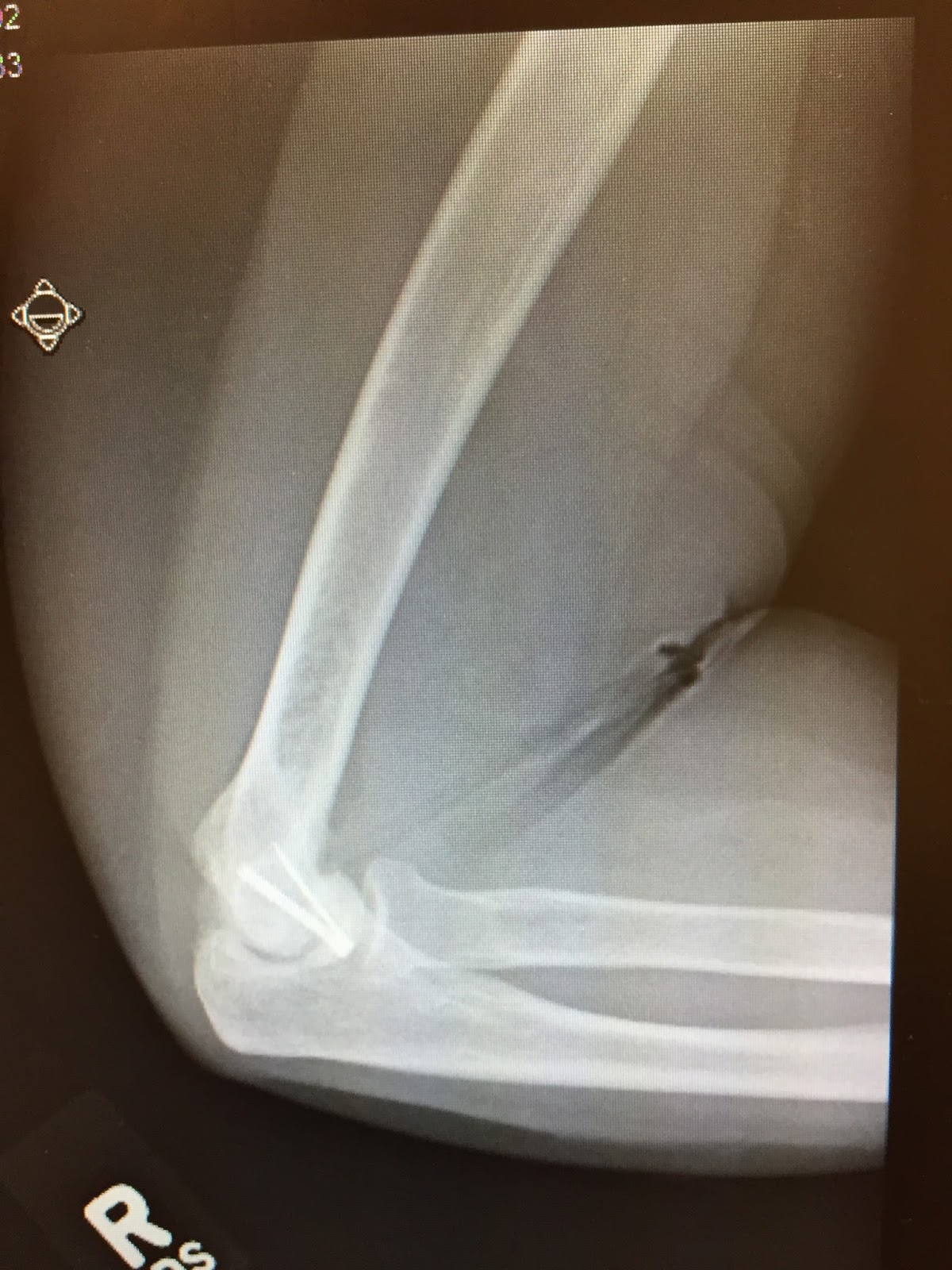 Shoulder and Elbow Surgery: Shear fractures of the capitellum.