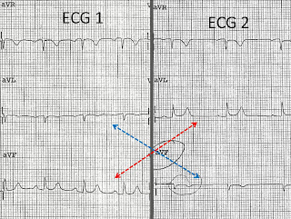 ECG of the Week: ECG of the Week - 18th March 2013 - Interpretation