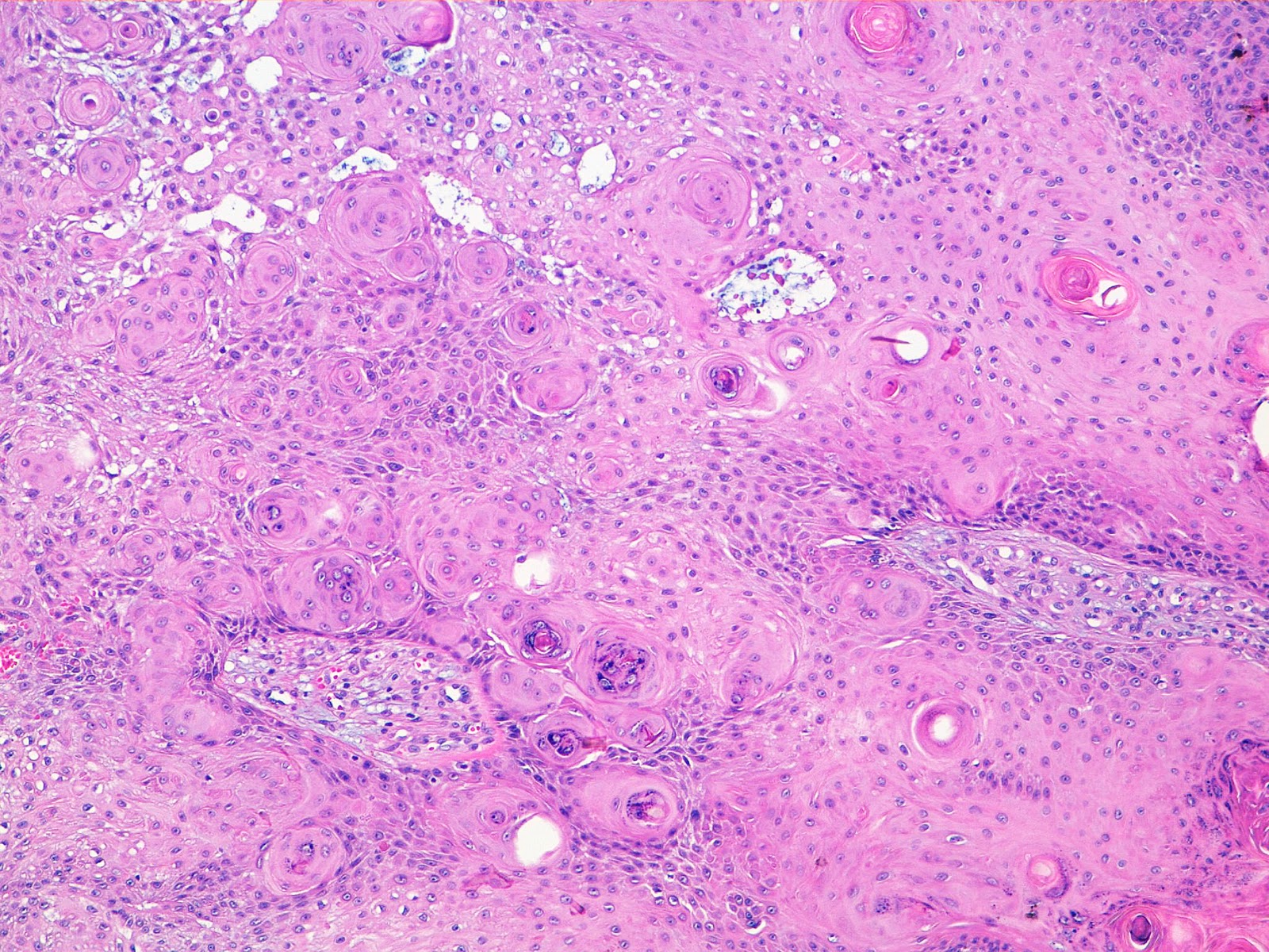 PATHfinder: Surgical Pathology Snapshot #7: skin lesion, leg.