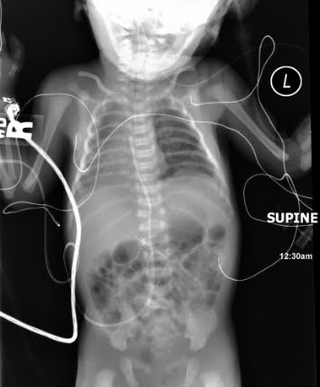 Pedi cardiology: CXR: Dextroposition & Dextrocardia/Situs inversus