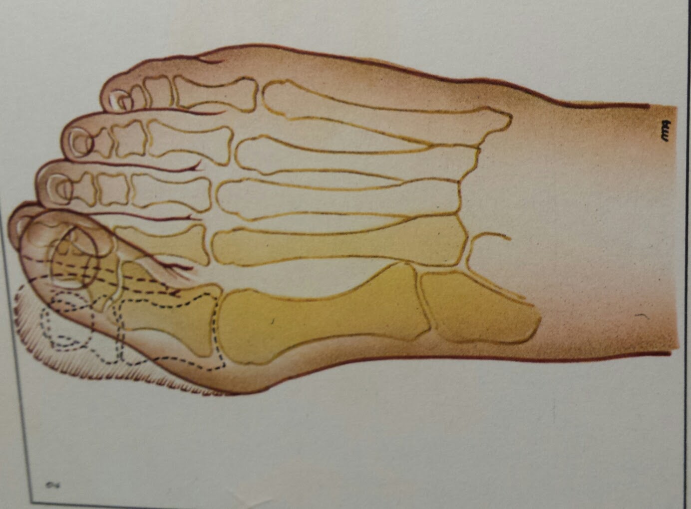 L'alluce valgo e il cedimento delle volte plantari