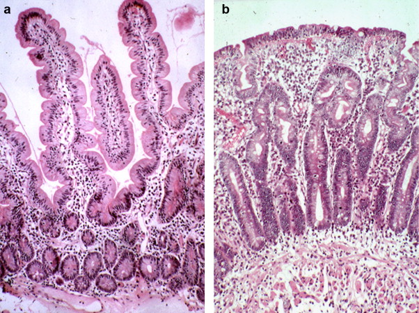 Maladie coeliaque; enteropathie au gluten; enteropathie chronique liee ...