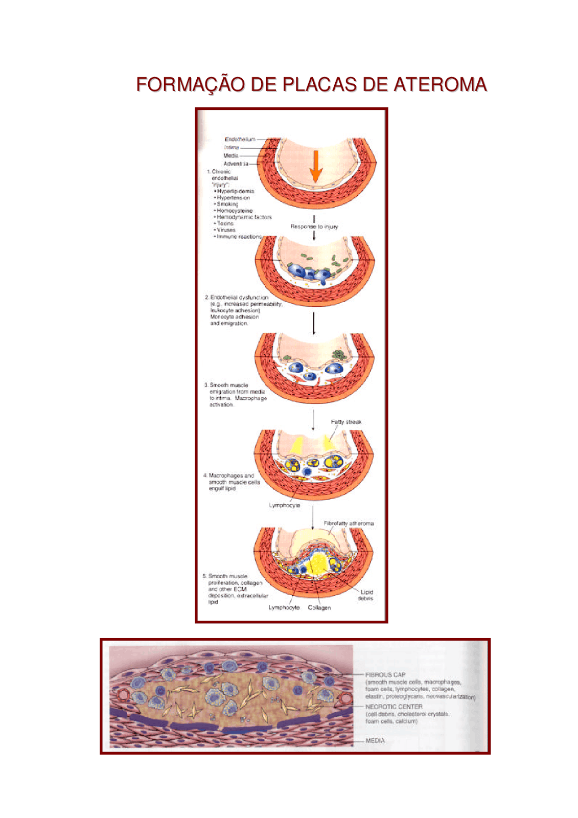 placa de ateroma - wood scribd braxin