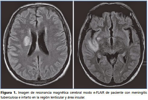 Parásitos, virus y bacterias: Meningitis