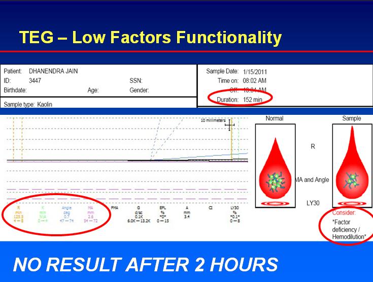 Thromboelastography TEG Analyzer Liver Transplant Cardiac Surgery India ...