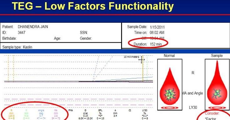 Thromboelastography TEG Analyzer Liver Transplant Cardiac Surgery India ...