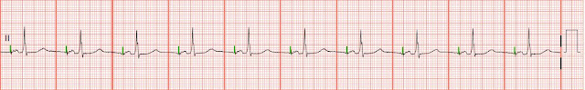 EKG Rhythm Strip Quiz 56: Paced Rhythms