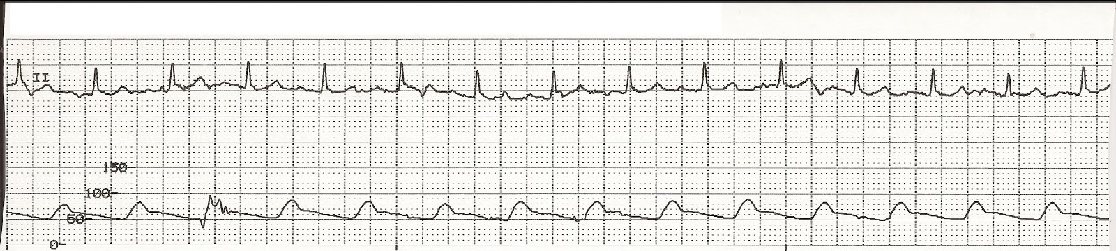 Various rhythms with arterial blood pressure waveform