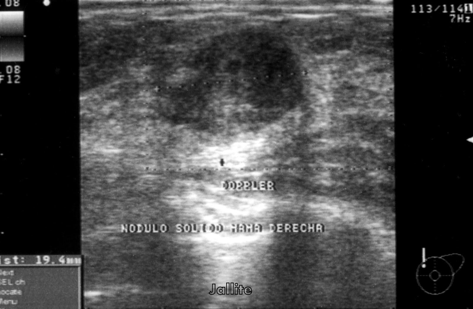 Fibroadenomas Mamarios Multiples